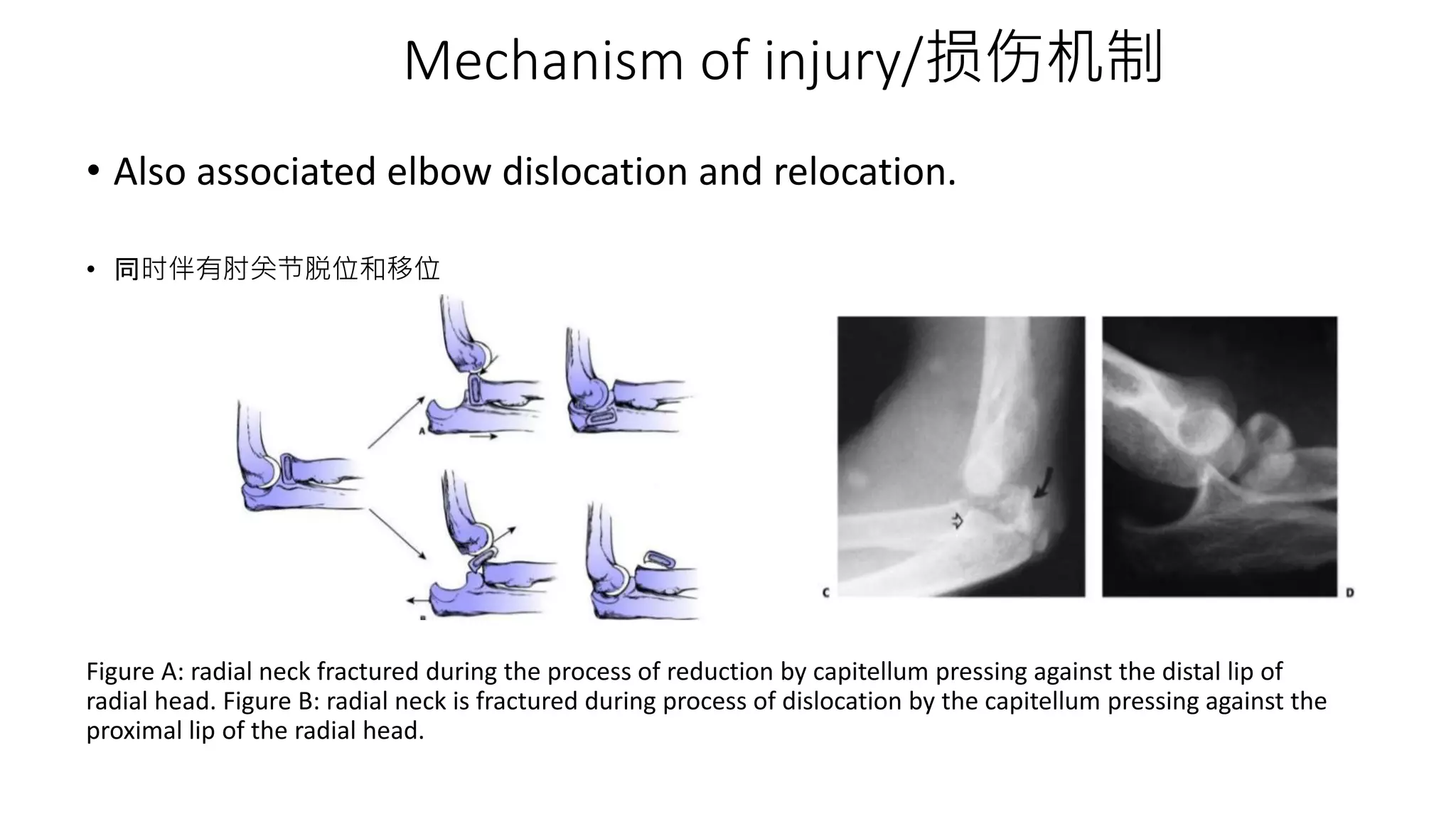 Radial neck fracture | PPTX