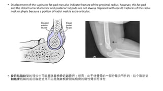 Radial neck fracture | PPTX