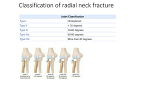 Radial neck fracture | PPTX