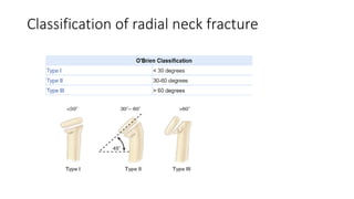 Radial neck fracture | PPTX