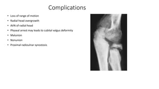 Radial neck fracture | PPTX