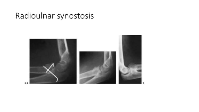Radial neck fracture | PPTX
