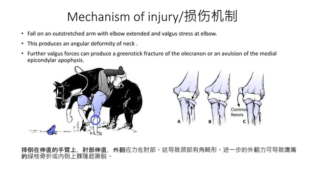 Radial neck fracture | PPTX