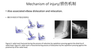 Radial neck fracture | PPTX