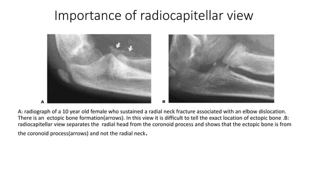 Radial neck fracture | PPTX
