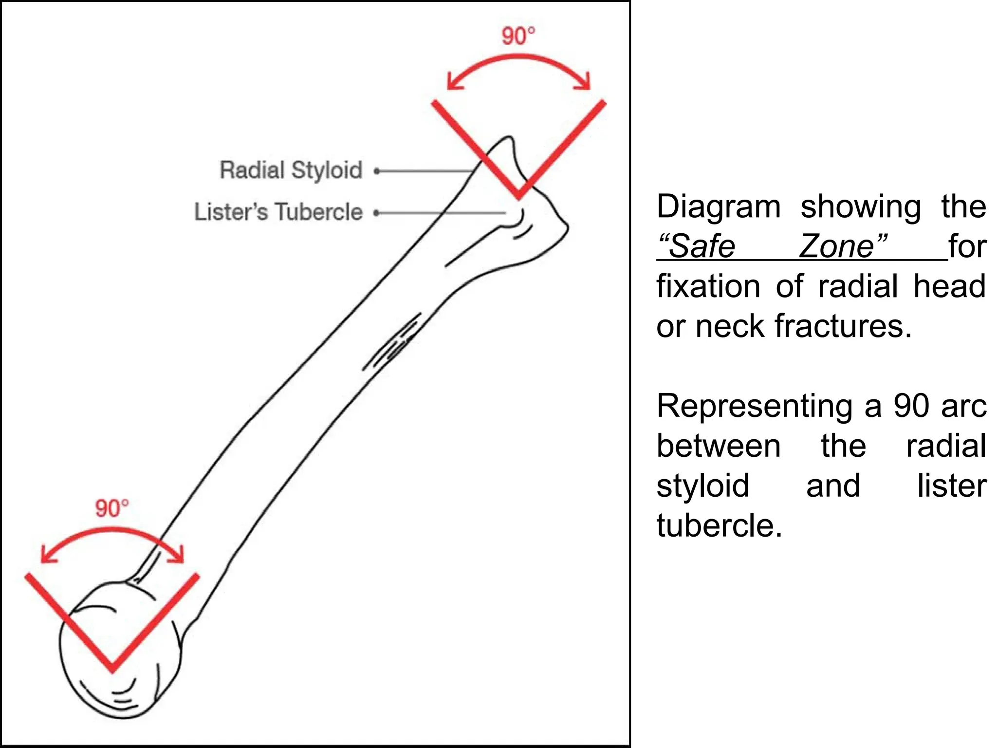 Radial neck fractures in childrens..pptx
