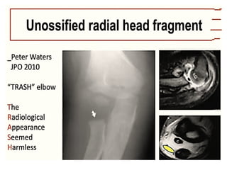 Radial neck fractures in childrens..pptx
