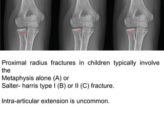 Radial neck fractures in childrens..pptx