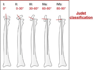Radial neck fractures in childrens..pptx