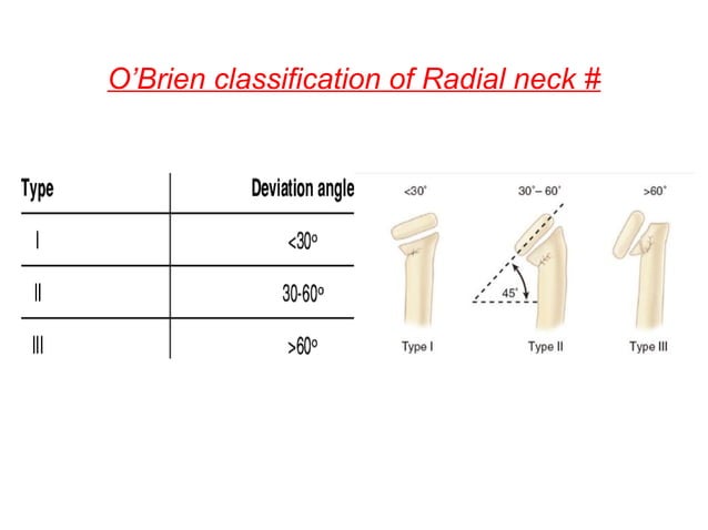 Radial neck fractures in childrens..pptx