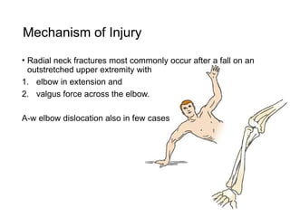 Radial neck fractures in childrens..pptx