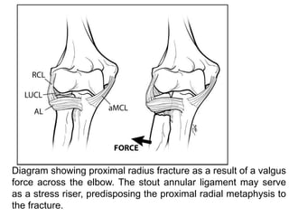 Radial neck fractures in childrens..pptx