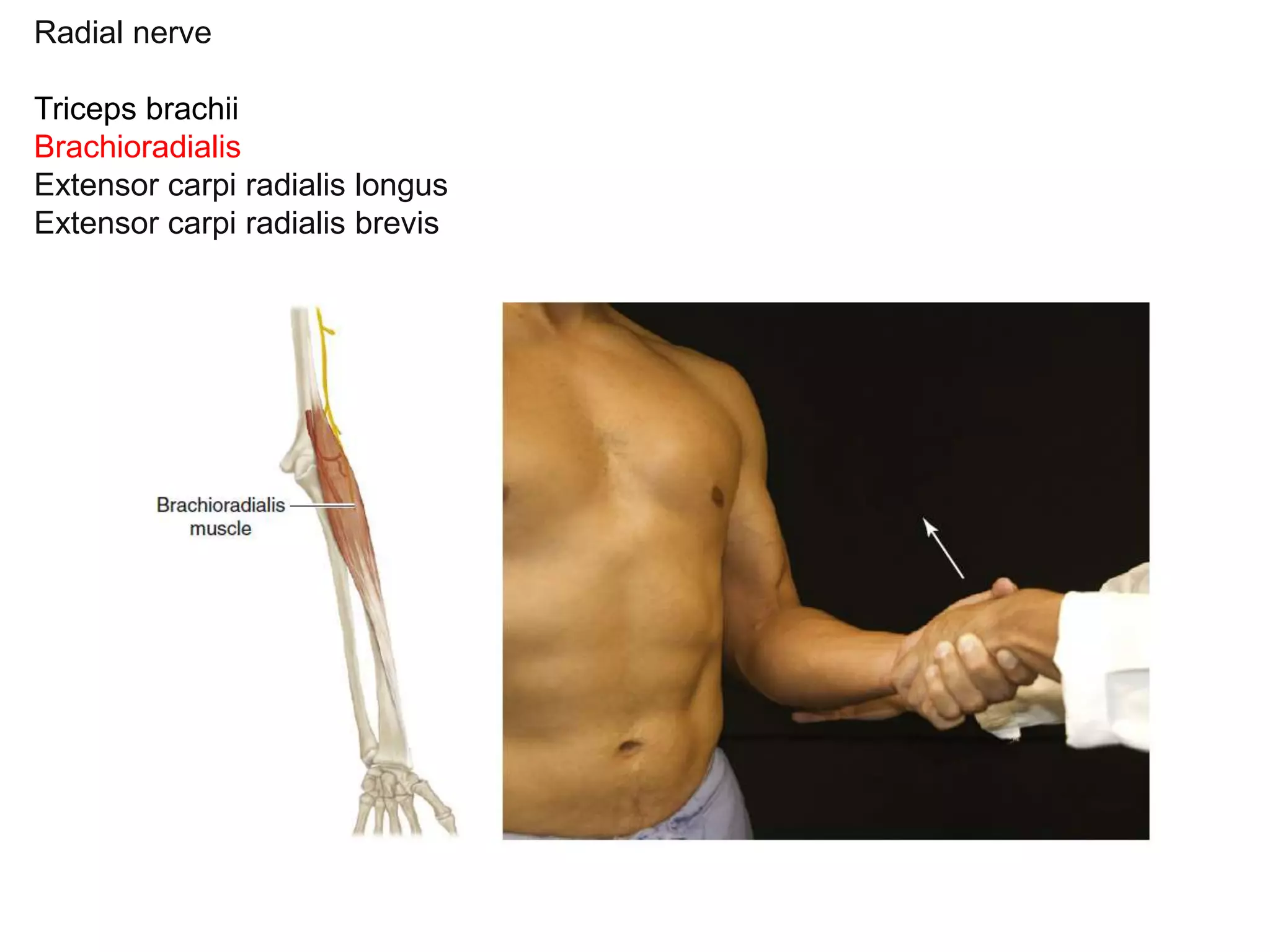 Radial nerve entrapment | PPTX