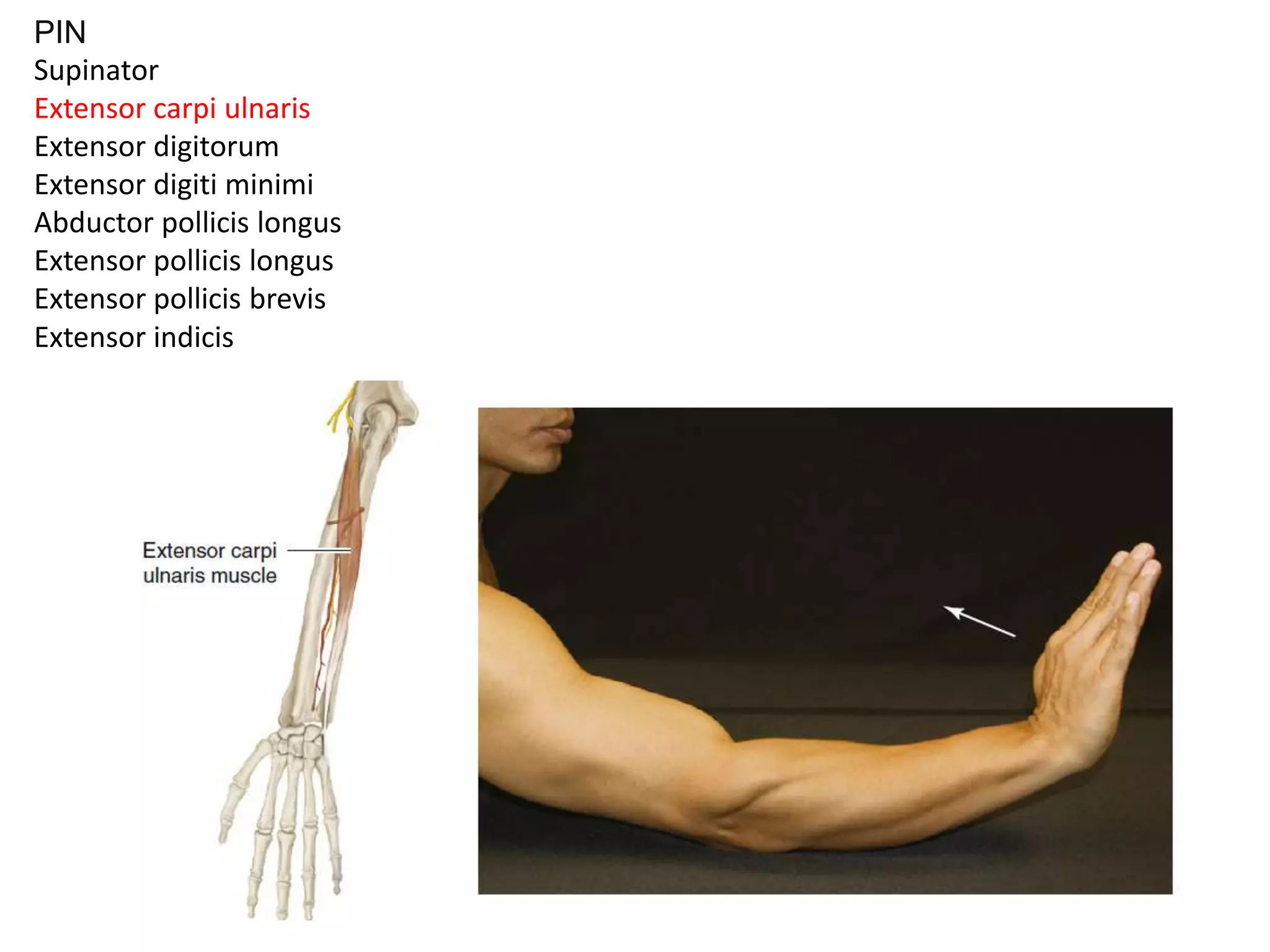 Radial nerve entrapment | PPTX