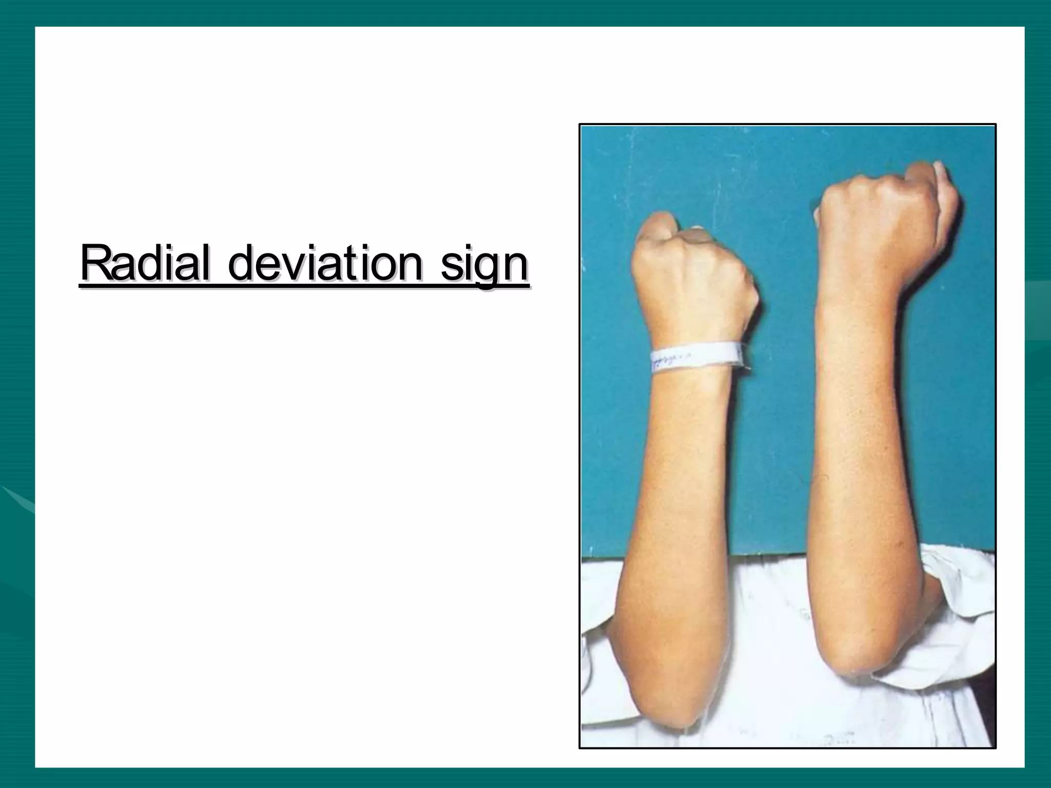 Radial nerve entrapment | PPT