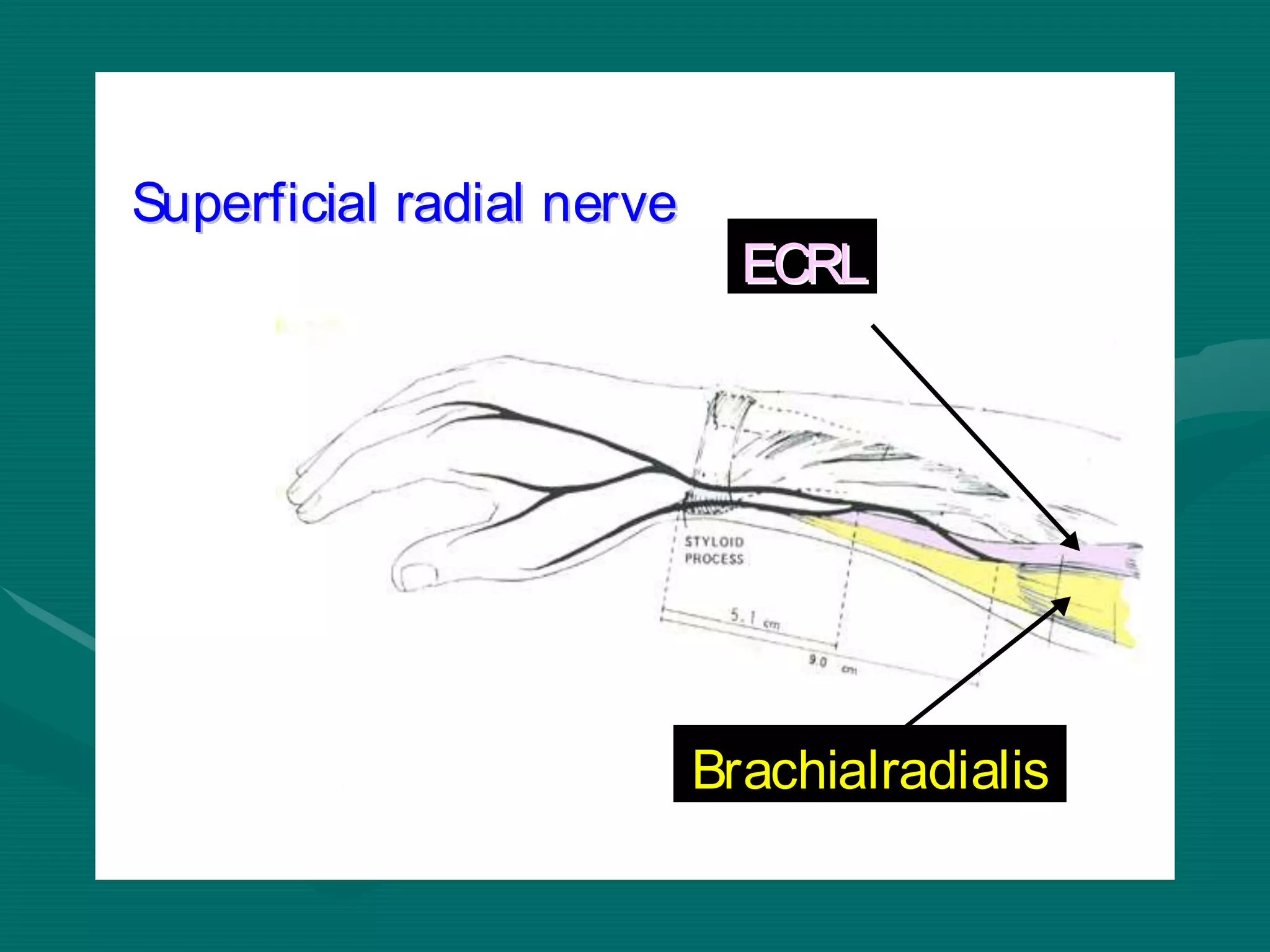 Radial nerve entrapment | PPT