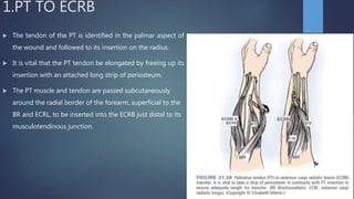Radial nerve anatomy and injuries | PPTX