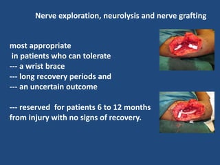 Radial nerve palsy | PPTX