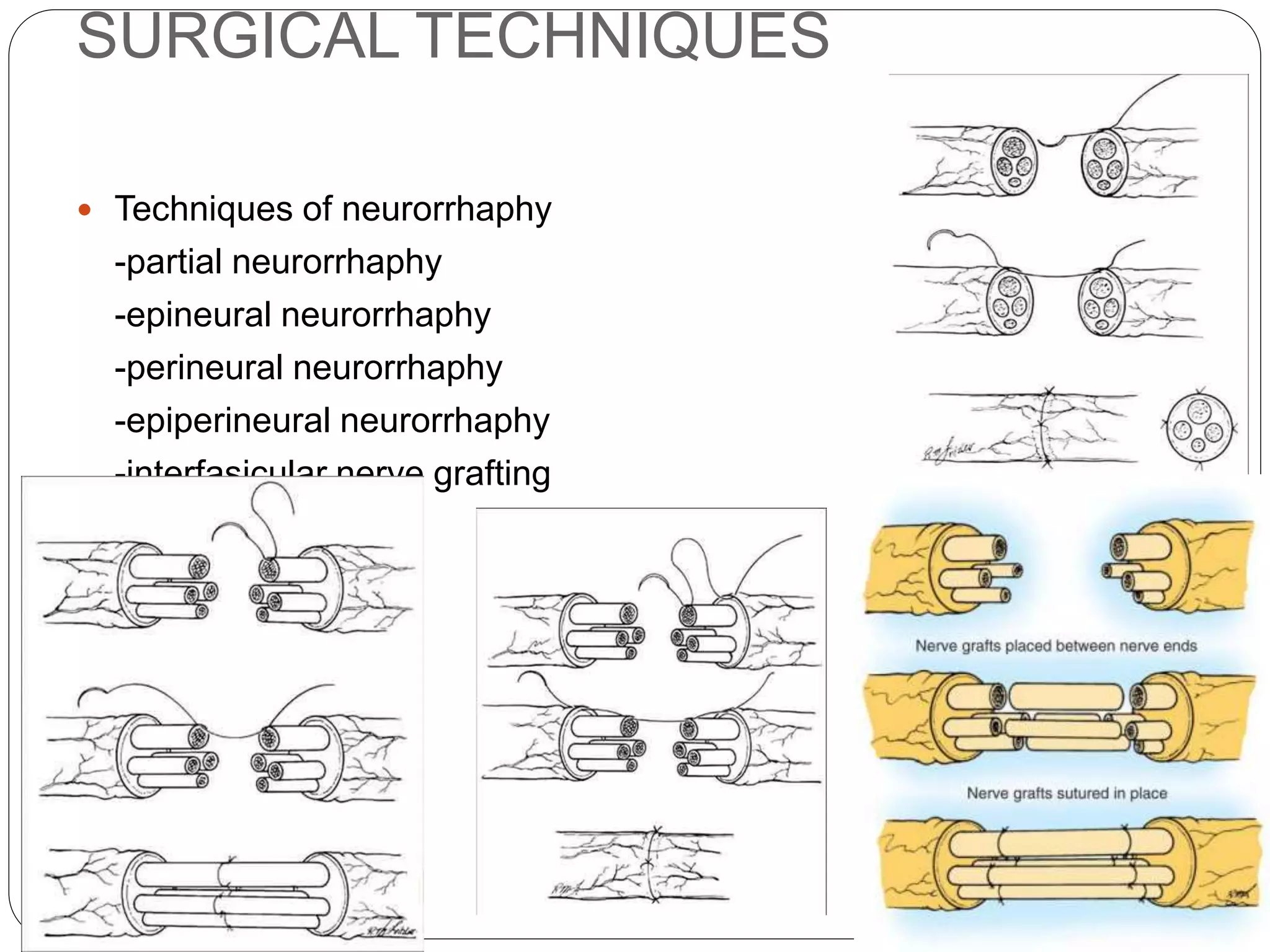 Radial nerve palsy | PPTX