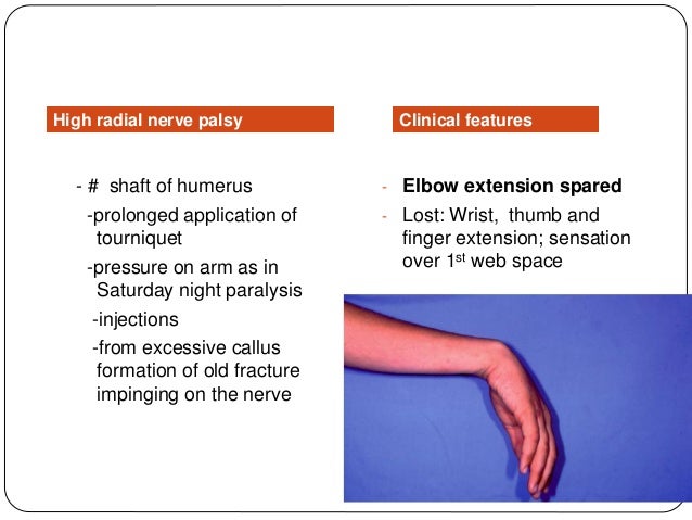 Radial Nerve Palsy Exercises Anime Telegram