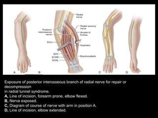 RADIAL NERVE palsy.pptx