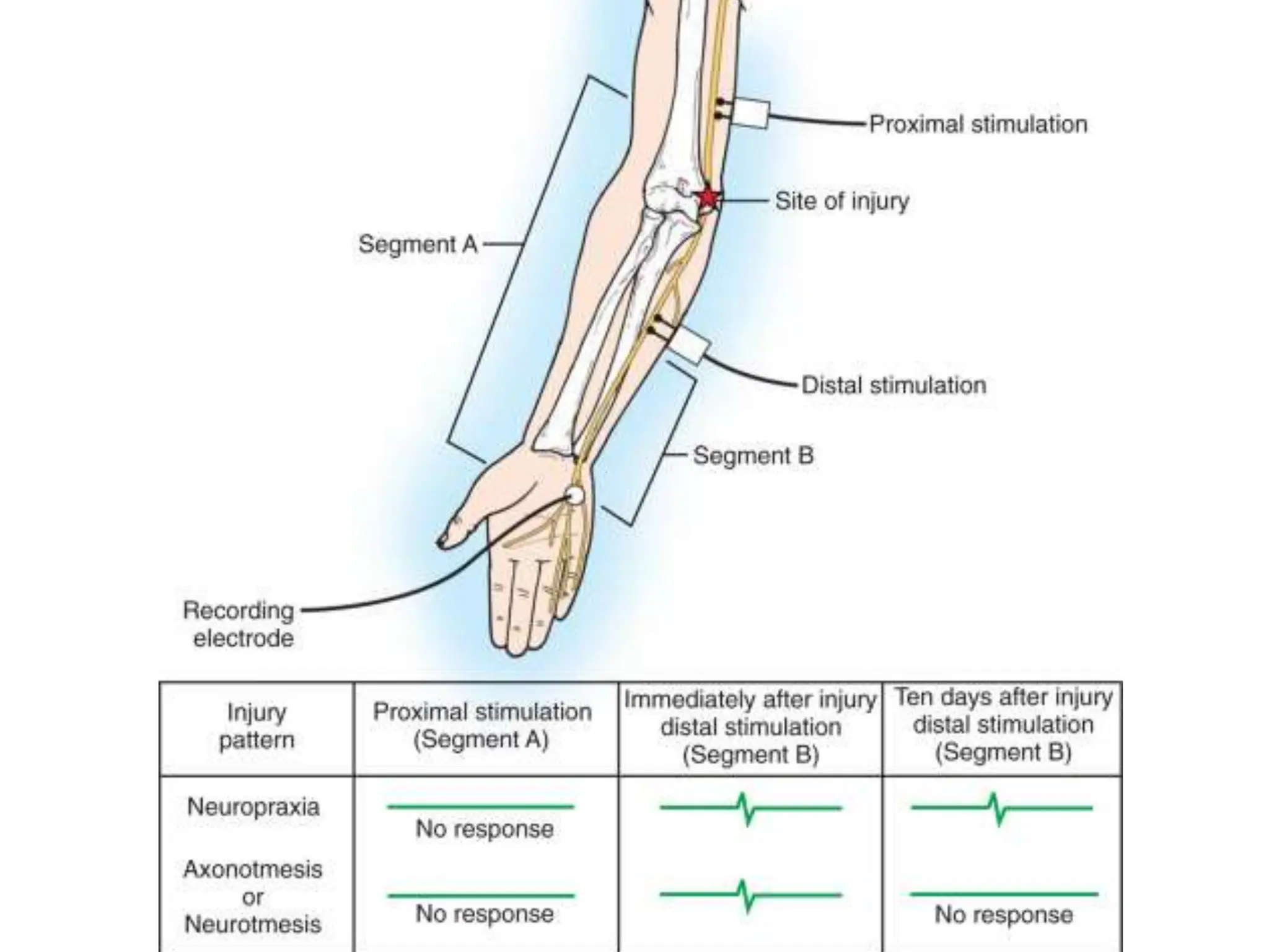 Radial Nerve palsy, Anatomy, Diagnosis and Management.pptx