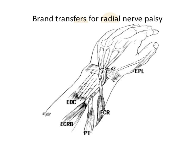 Radial nerve palsy tendon transfersw