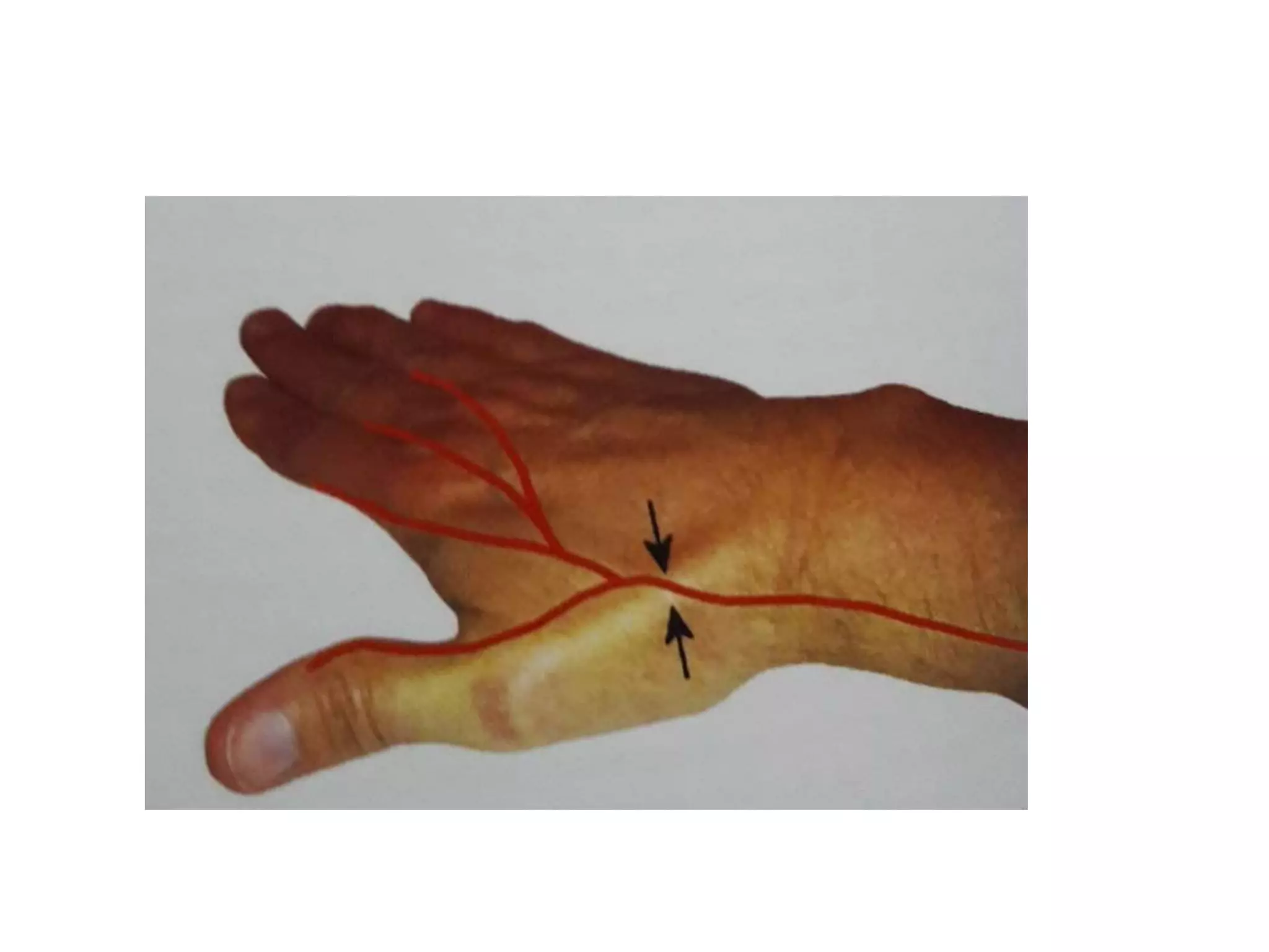 Radial neuropathy and electrophysiology | PPTX