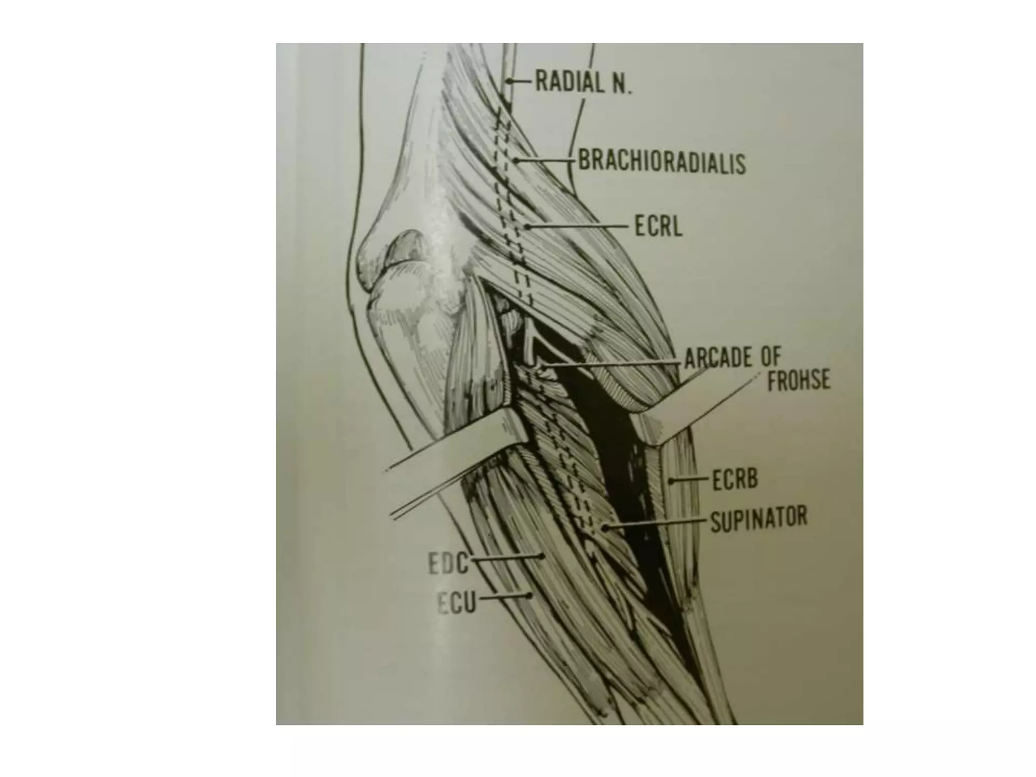 Radial neuropathy and electrophysiology | PPTX