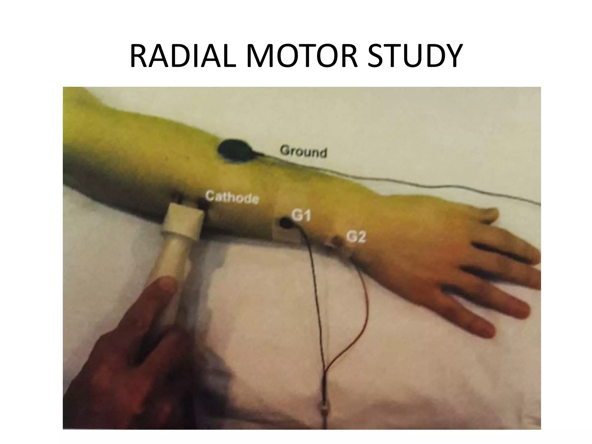 Radial neuropathy and electrophysiology | PPTX
