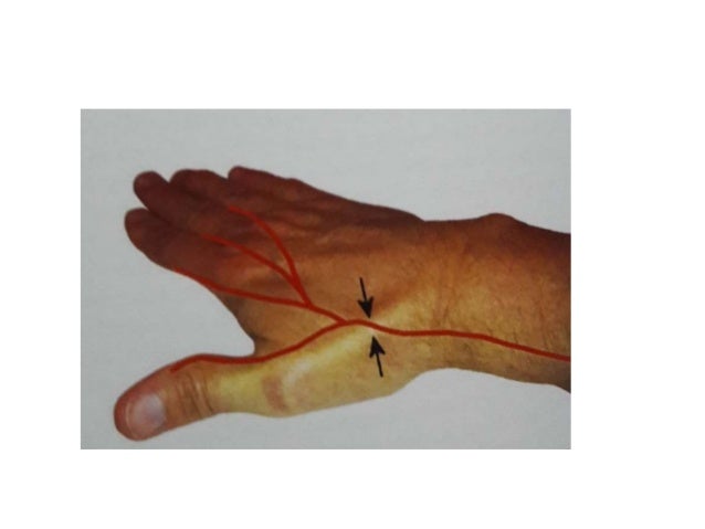 Radial neuropathy and electrophysiology