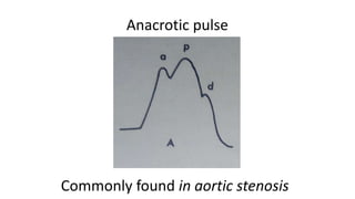 Carotid Pulse Tracing