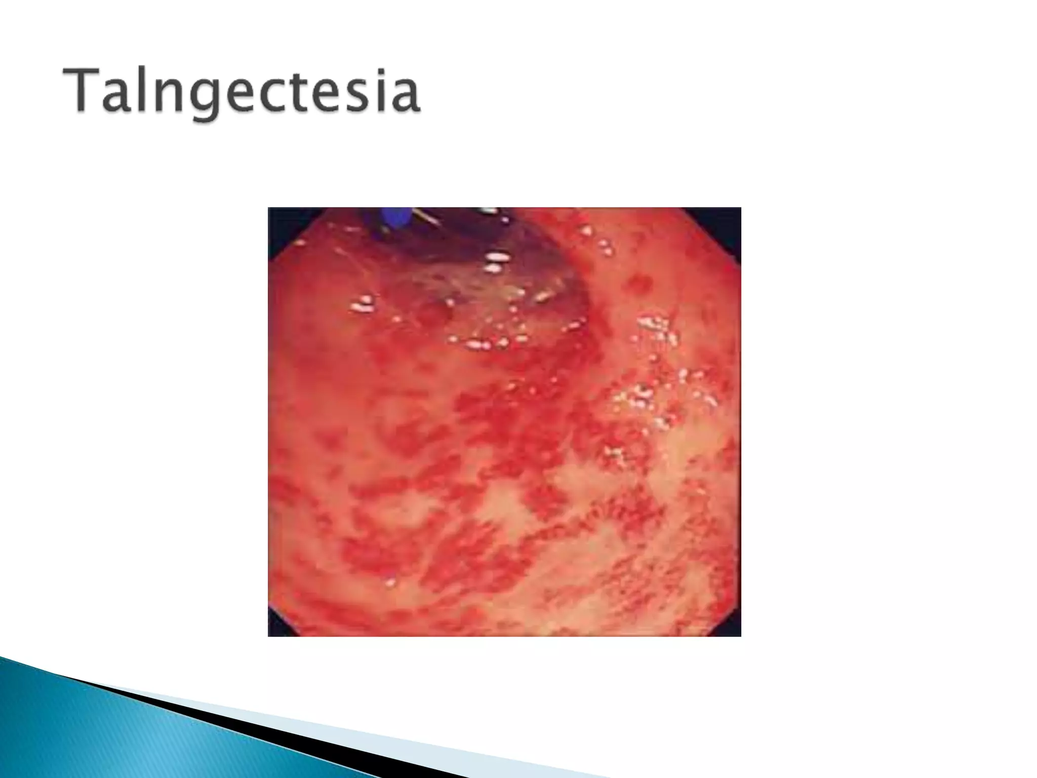 Radiation cystitis MANAGEMNT | PPT