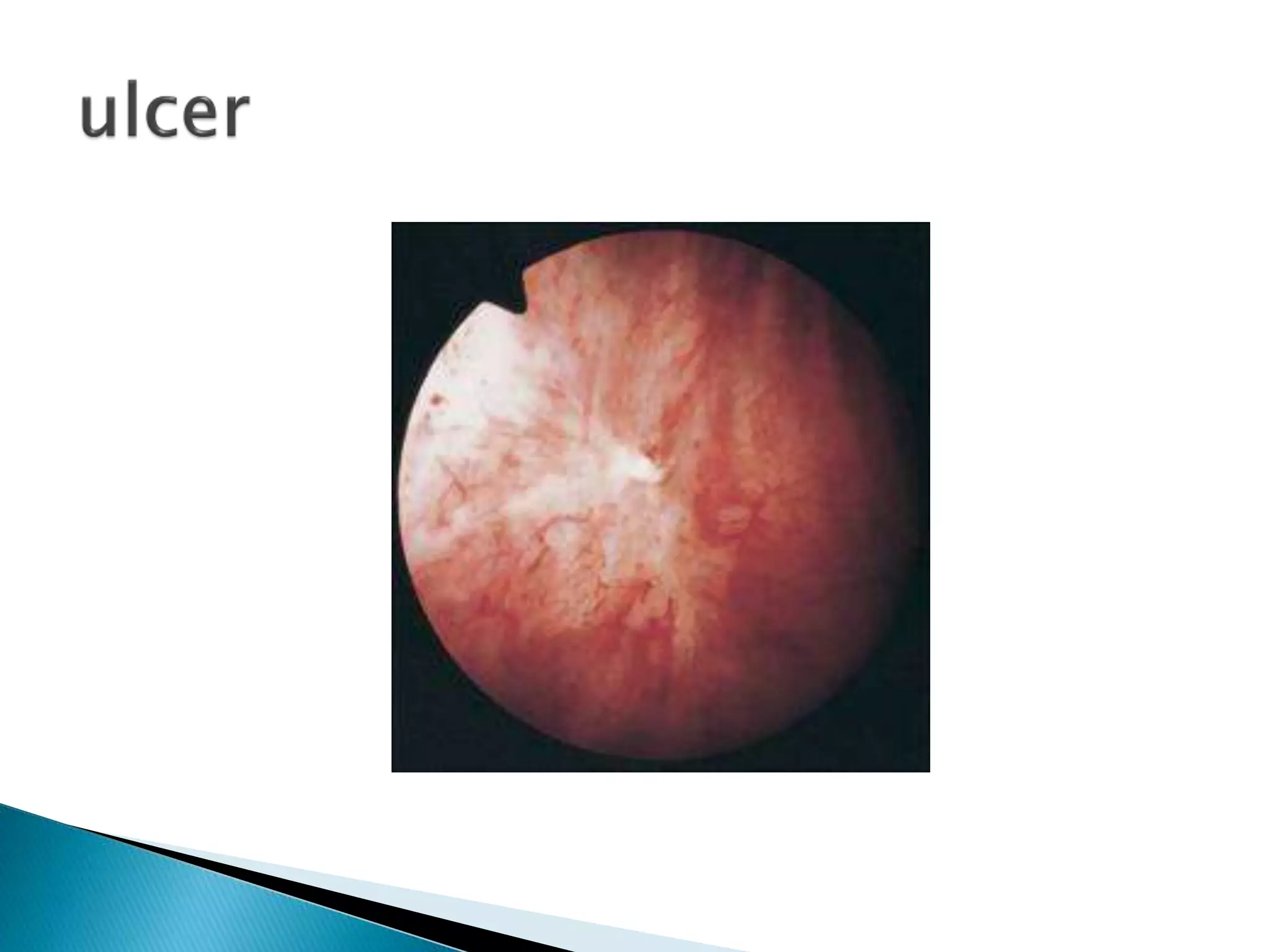 Radiation cystitis MANAGEMNT | PPT