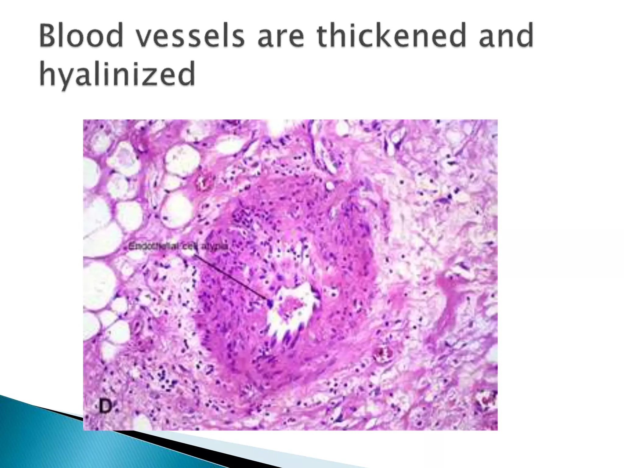 Radiation cystitis MANAGEMNT | PPT