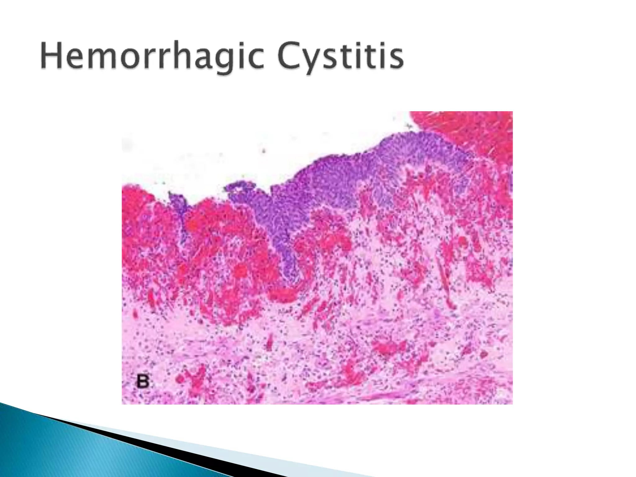 Radiation cystitis MANAGEMNT | PPT