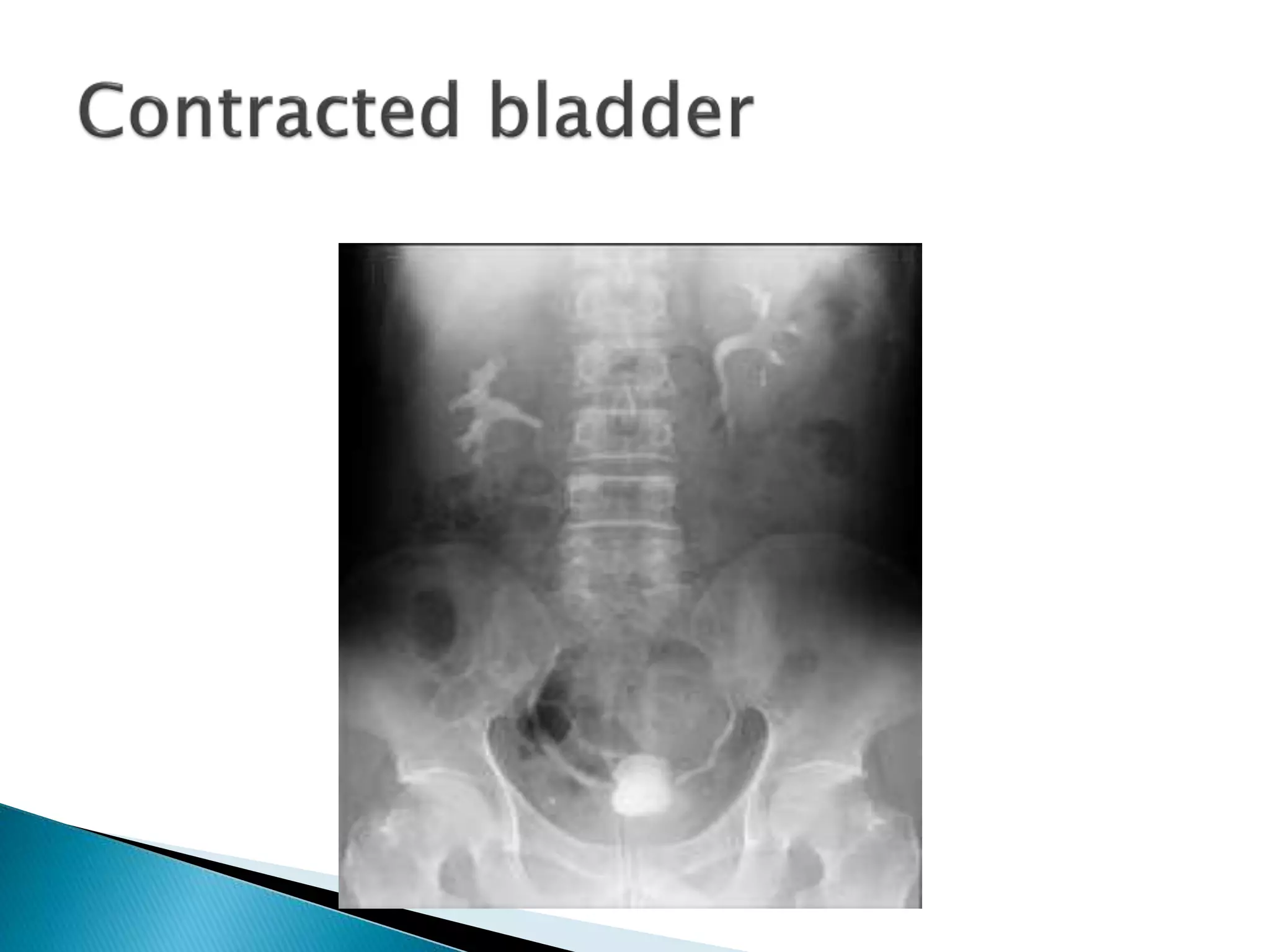 Radiation cystitis MANAGEMNT | PPT