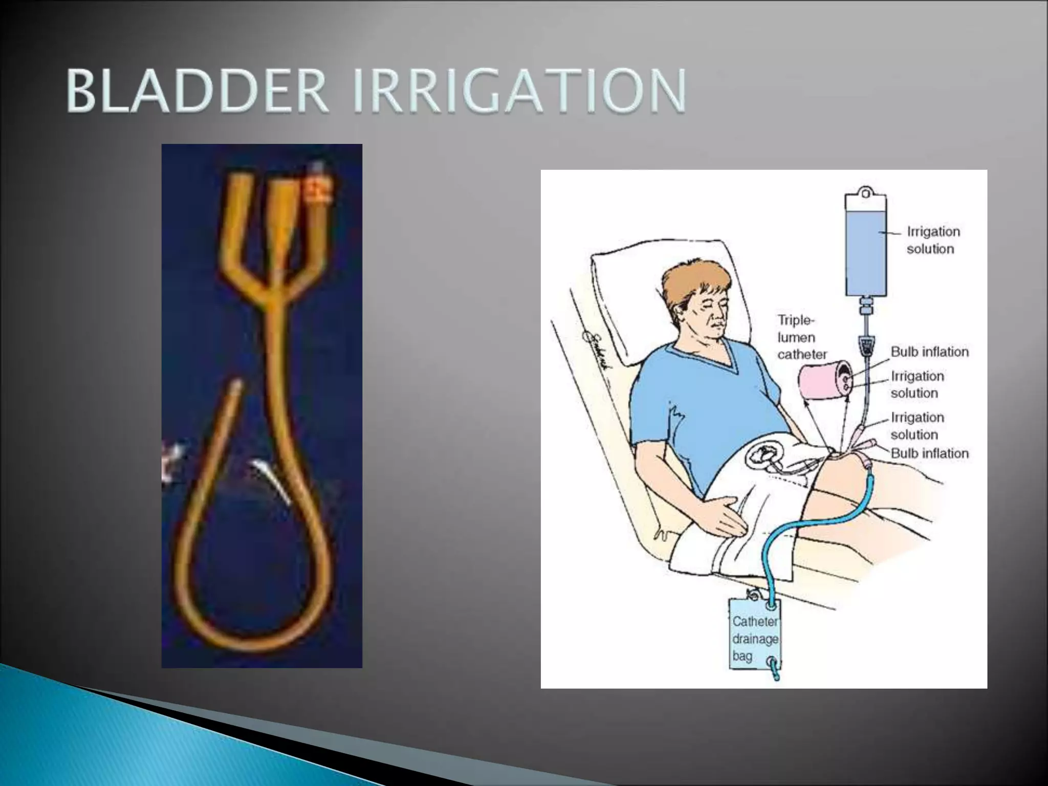 Radiation cystitis MANAGEMNT | PPT