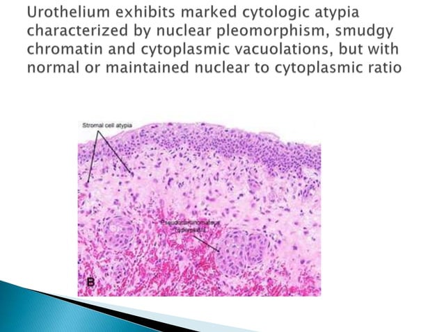 Radiation cystitis MANAGEMNT | PPT