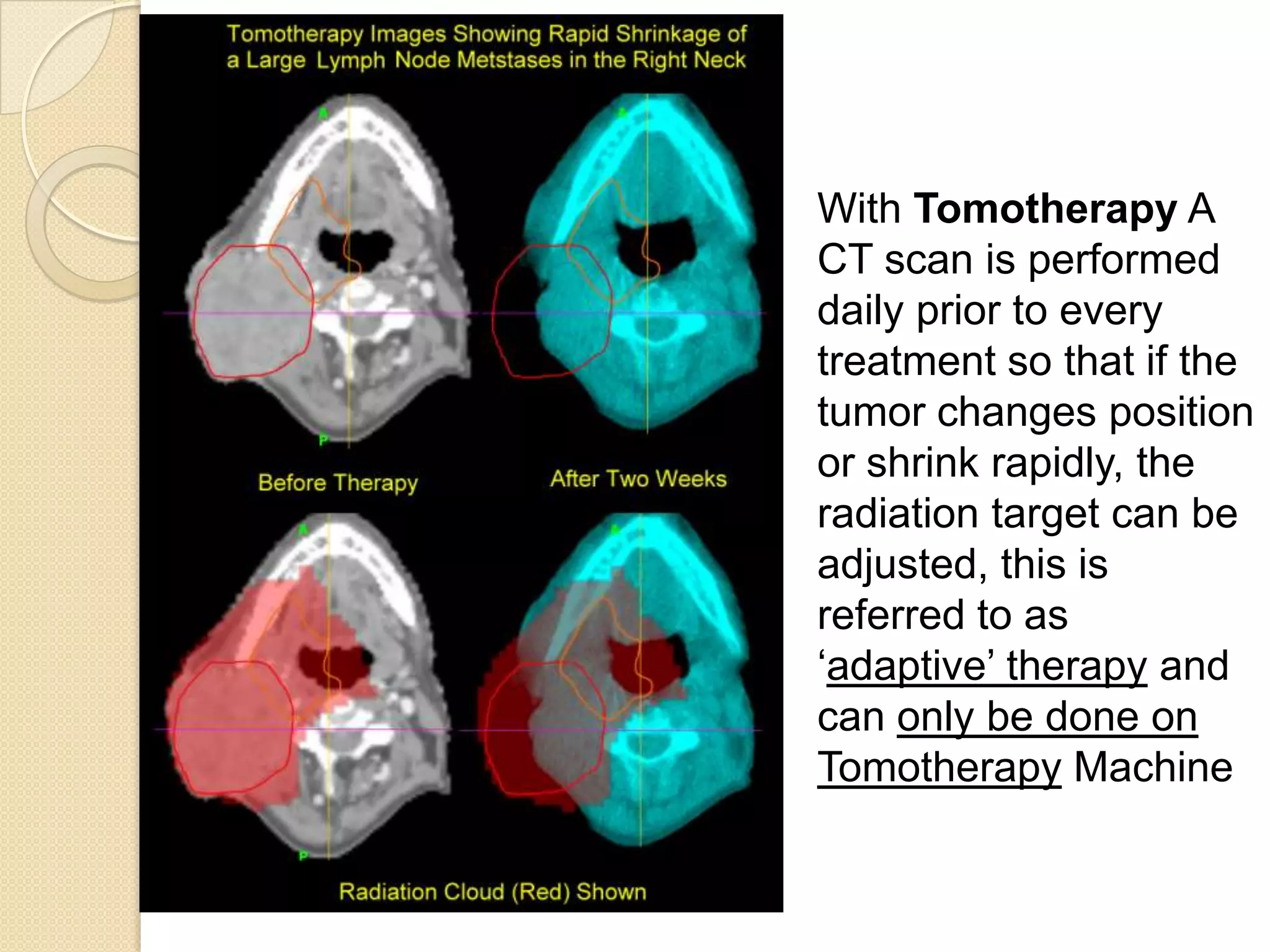 Radiation for head and neck cancer video | PPTX