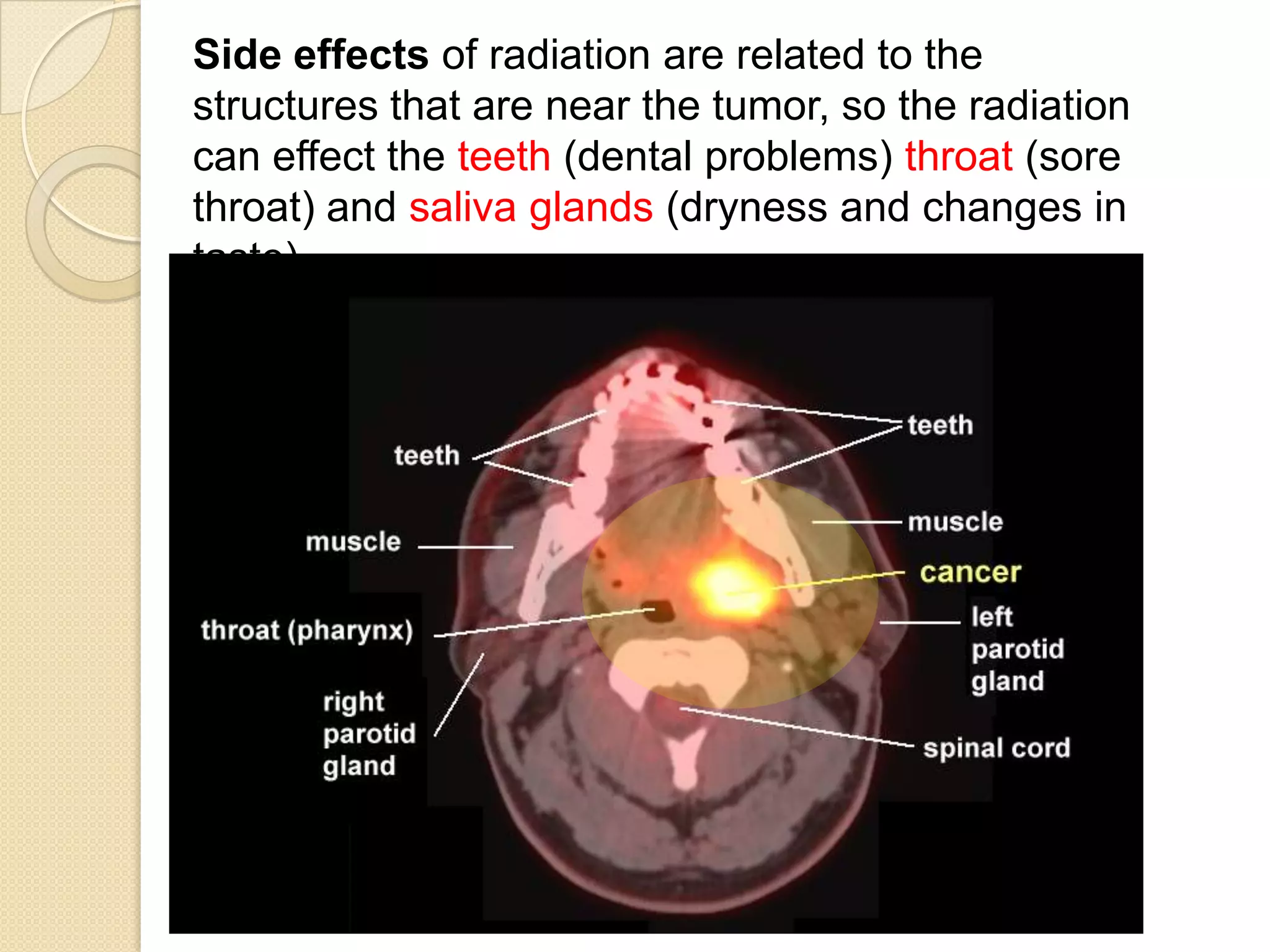 Radiation for head and neck cancer video | PPTX