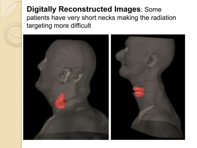 Radiation for head and neck cancer video | PPTX | Ear, Nose and Throat ...