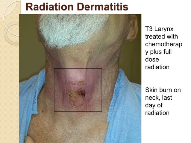 Radiation for head and neck cancer video | PPTX | Ear, Nose and Throat ...