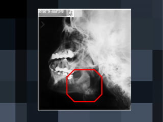 Radiation induced sarcomas in head and neck | PPT