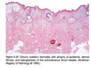 Radiation injury | PPTX
