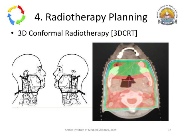 Radiation in oral cancers | PPTX
