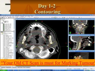 Radiation planning steps | PPT