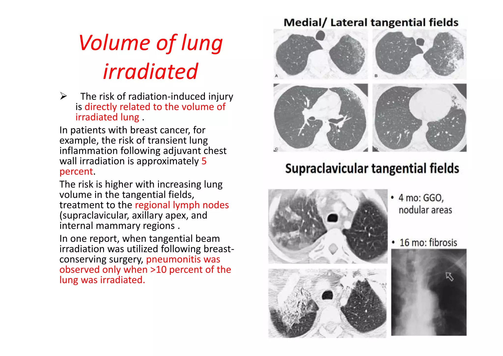 Radiation Pneumonitis | PDF