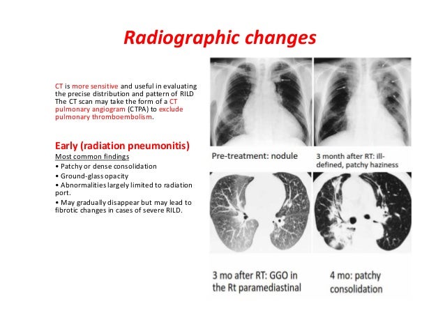 Radiation Pneumonitis