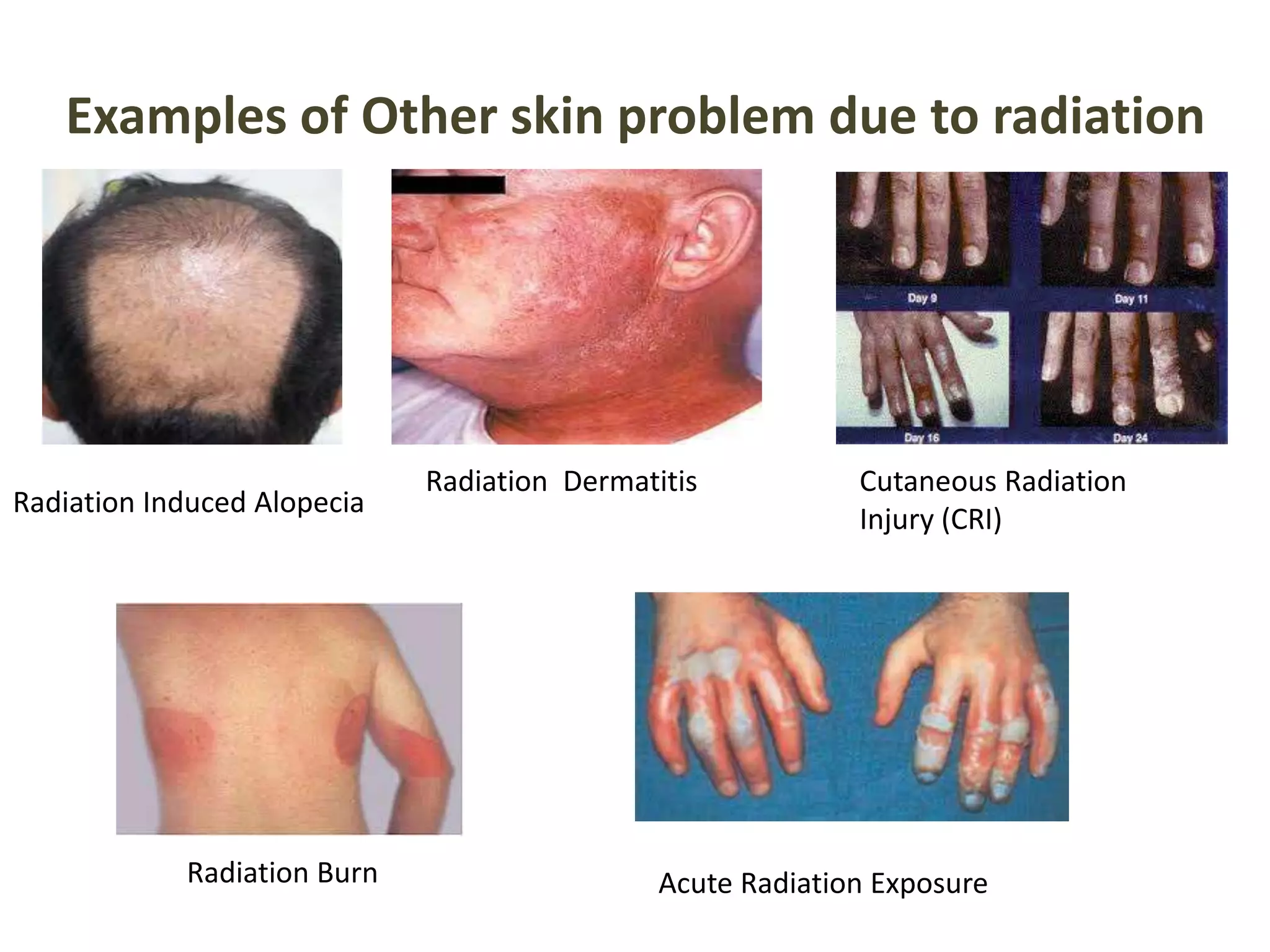 RADIATION POISONING 1 pptx